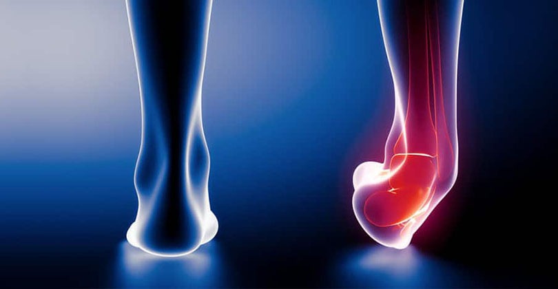 Jatuh dan Cedera Ligamen di Ankle | iKurniawan